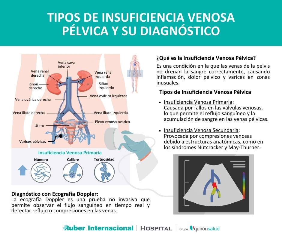 Diagnóstico De La Insuficiencia Venosa Pélvica Con Ecografía Doppler